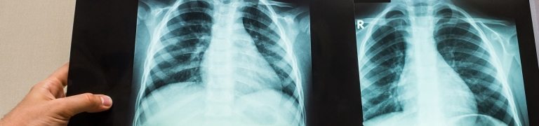 Longembolie - Trombosestichting