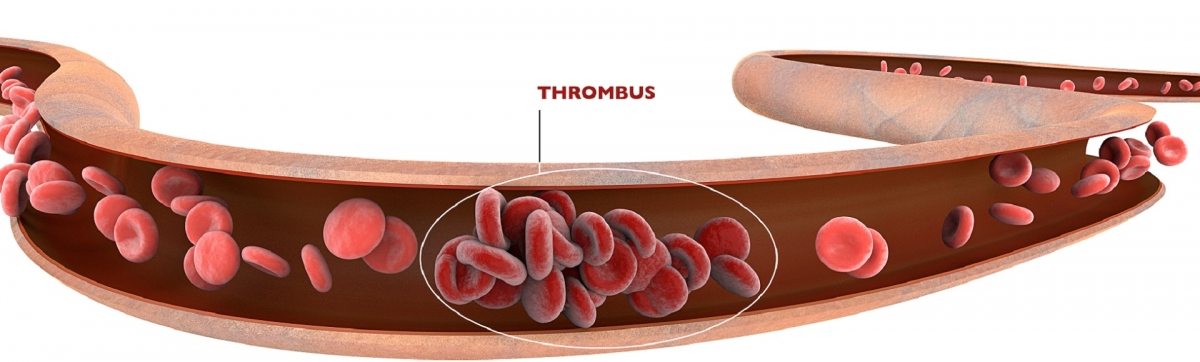 Trombose - Trombosestichting