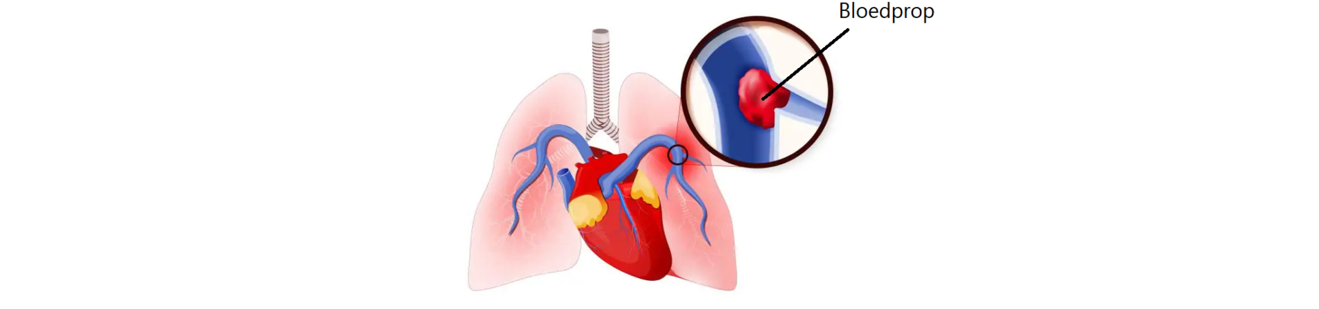 Wat is een longembolie? Symptomen en diagnose. - Trombosestichting