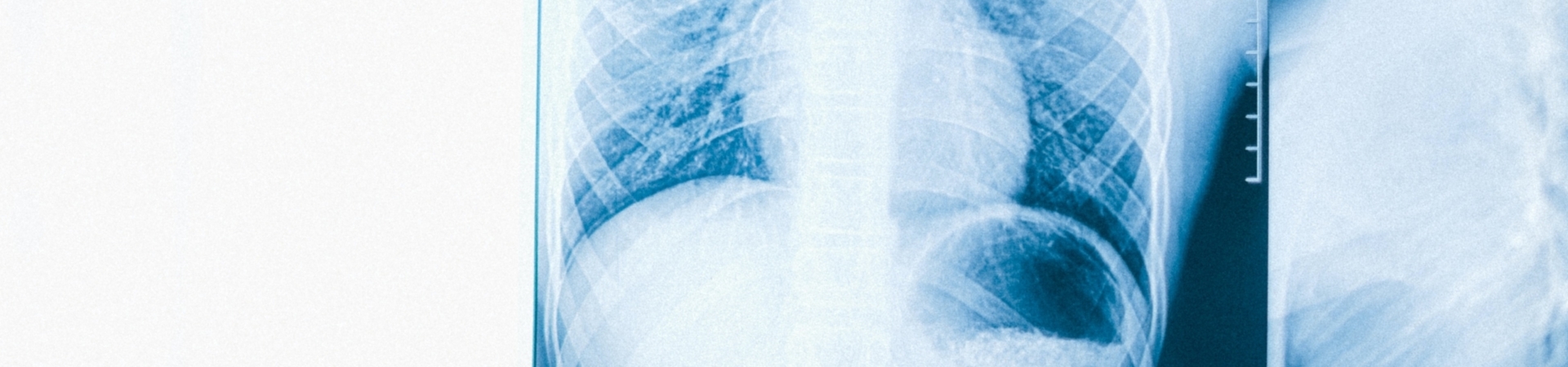 Wat zijn de symptomen van longembolie? - Trombosestichting
