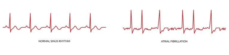 sinus ritme boezemfibrilleren ecg hartfilmpje - Trombosestichting