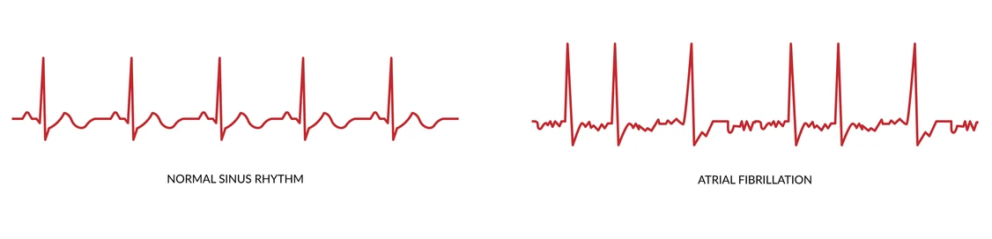sinus ritme boezemfibrilleren ecg hartfilmpje - Trombosestichting